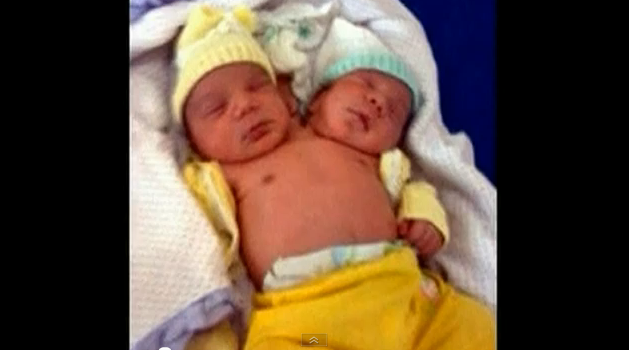 Two-Headed Baby Born in Brazil
